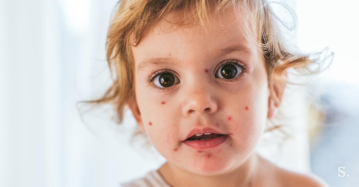 Norice: kako jih prepoznati in ukrepati - siol.net