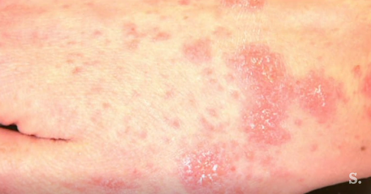 Na Gorenjskem so se pojavile garje - siol.net