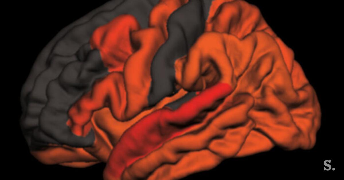 Odkrili povezavo med pomanjkanjem kakovostnega spanca in Alzheimerjevo ... Odkrili povezavo med pomanjkanjem kakovostnega spanca in Alzheimerjevo ...